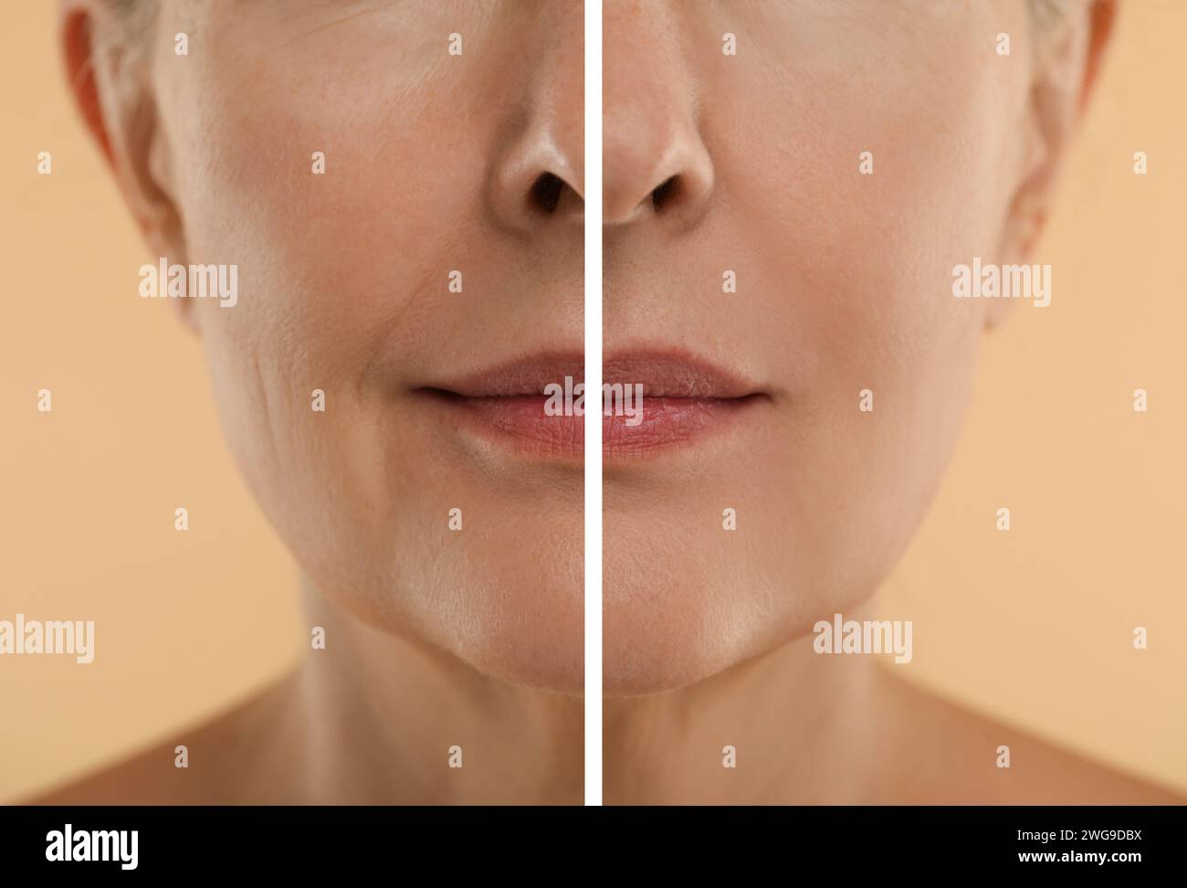 Aging skin changes. Woman showing neck before and after rejuvenation ...