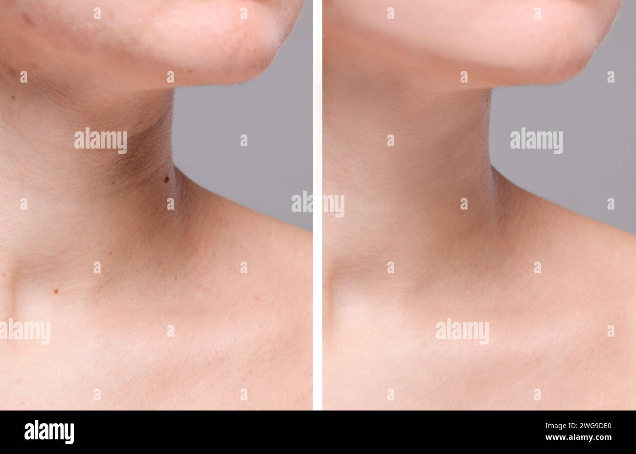 Aging skin changes. Woman showing neck before and after rejuvenation ...