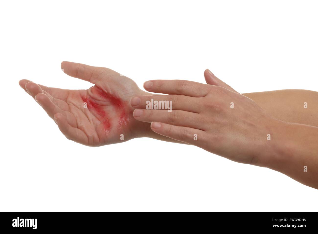 Burn mark on hand hi-res stock photography and images - Alamy