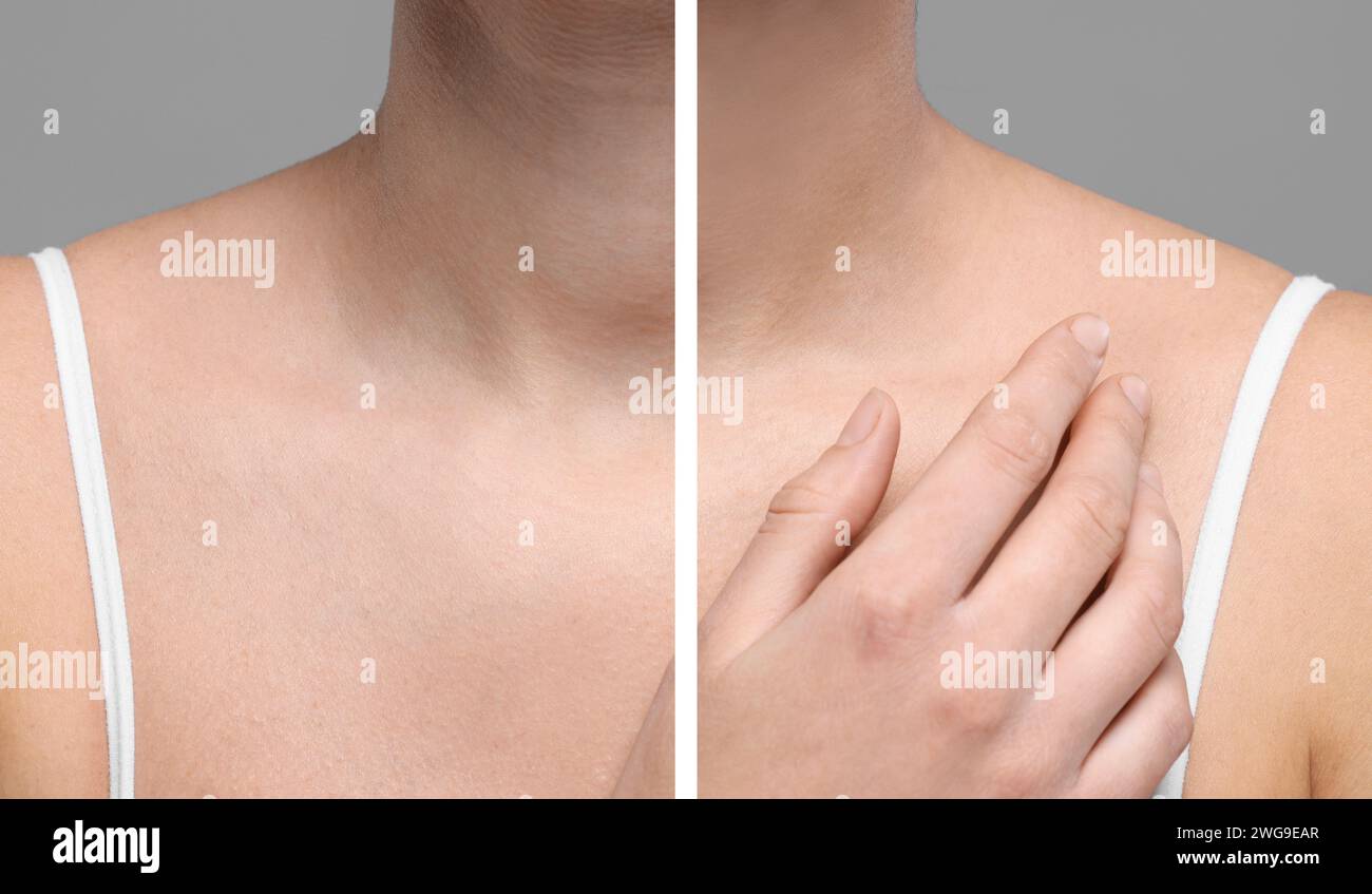 Aging skin changes. Woman showing neck before and after rejuvenation ...