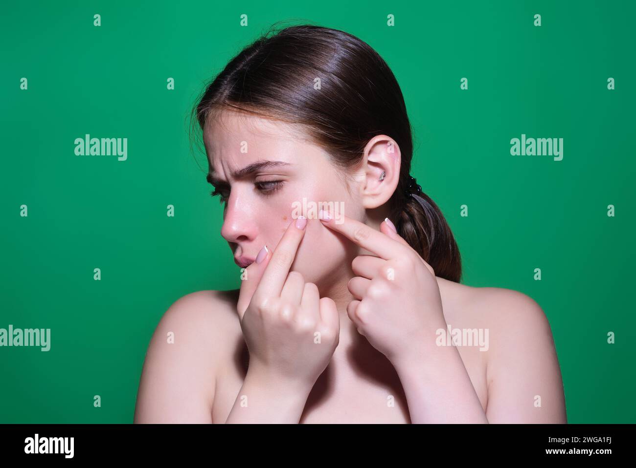 Sad Woman squeeze out pimples on cheek. Acne and pimple on skin ...