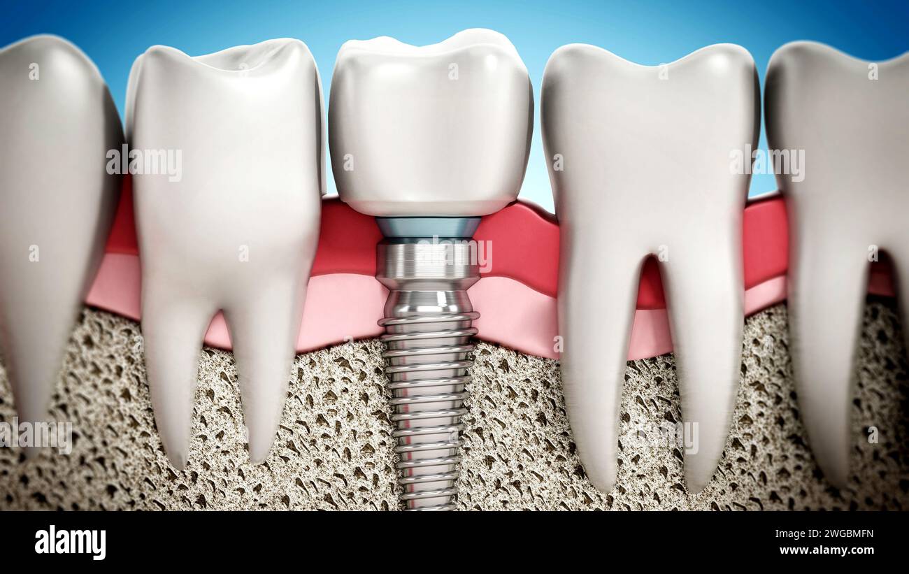 3D rendering of tooth implant showing jaw gum and bone layers. 3D ...