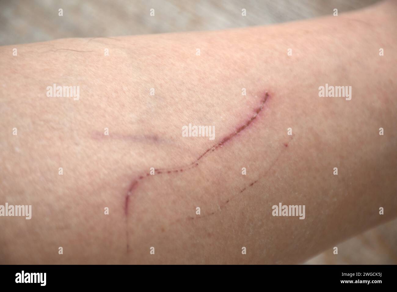 Suture infection hi-res stock photography and images - Alamy