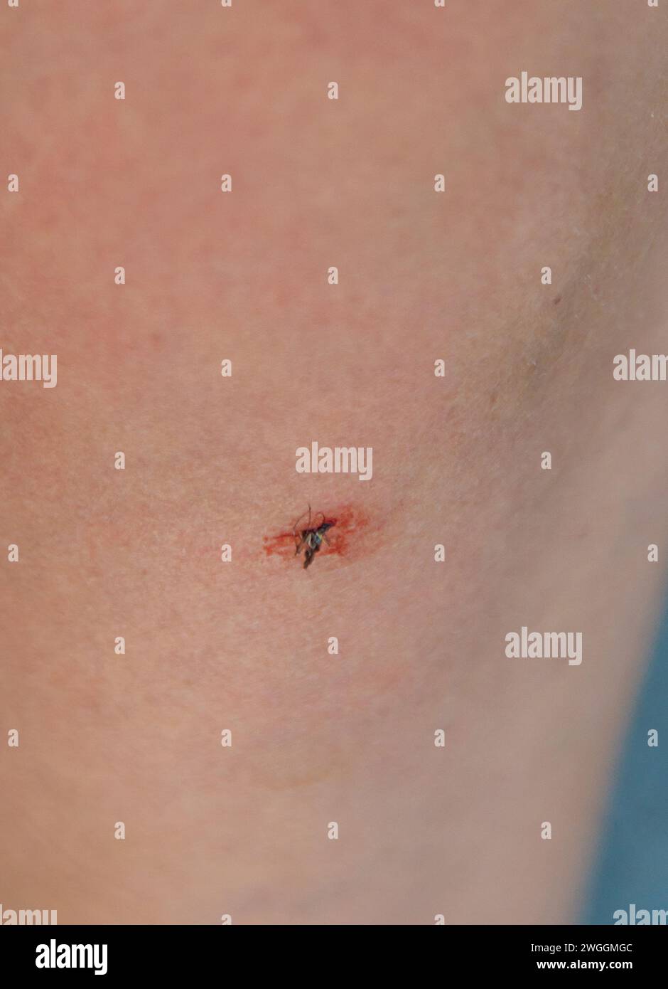 Mosquito foot bites hi-res stock photography and images - Alamy