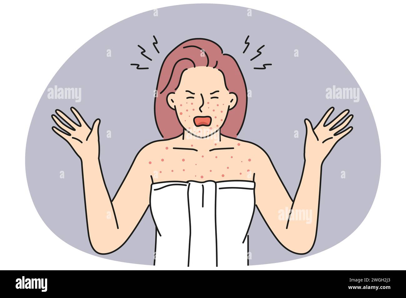 Angry woman in towel shout distressed with red body inflammation ...