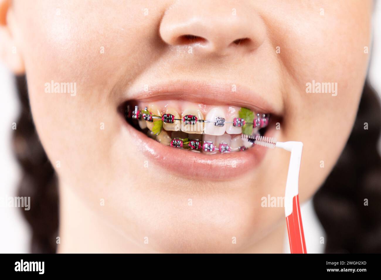 Close up of young Caucasian woman with brackets on dirty teeth cleaning ...