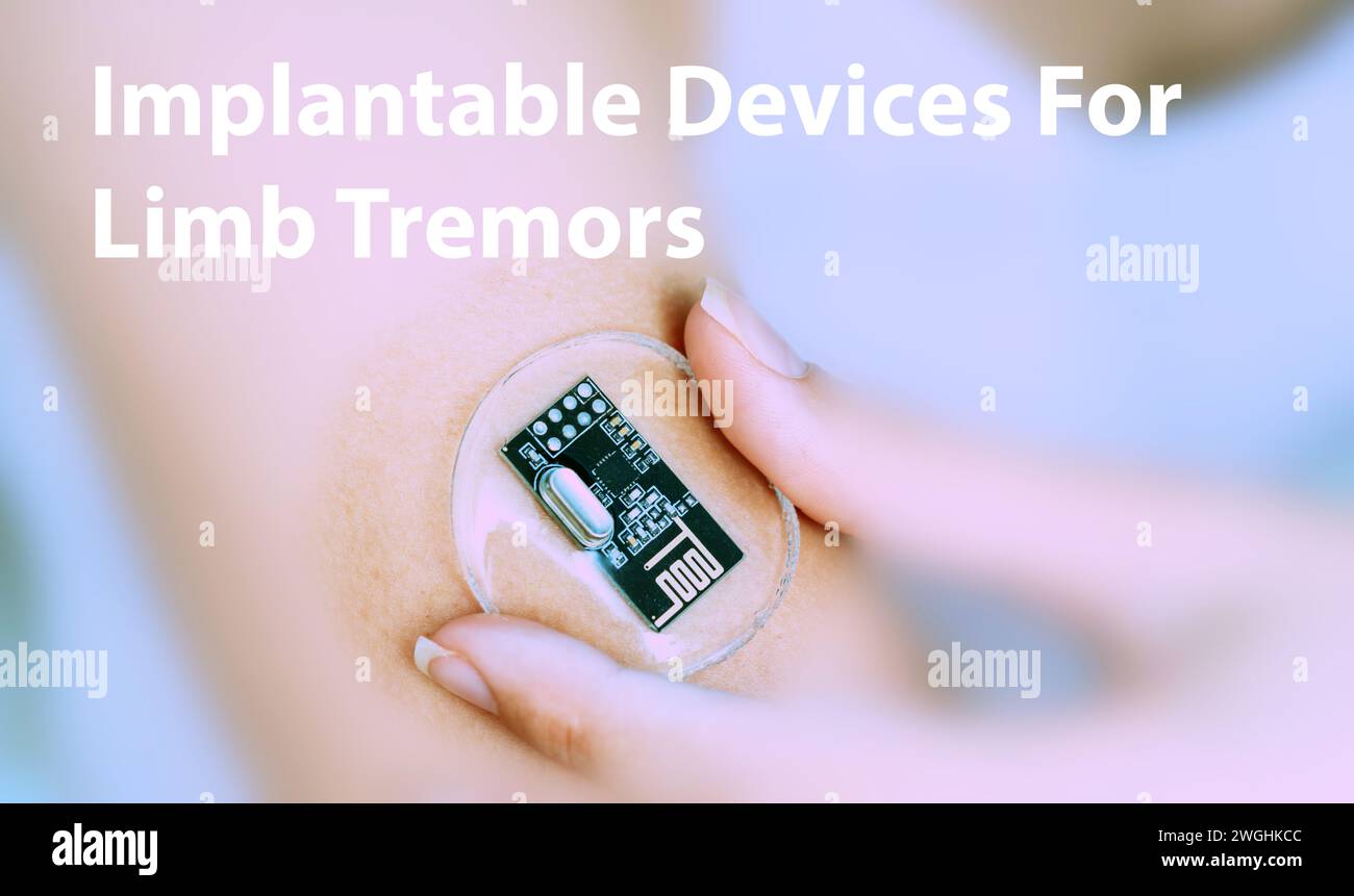 Deep brain stimulation hi-res stock photography and images - Alamy