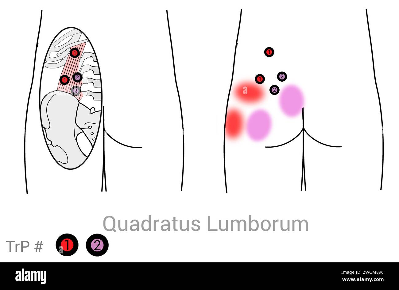 Quadratus lumborum myofascial trigger points can create referred and local pain in the pelvis ...