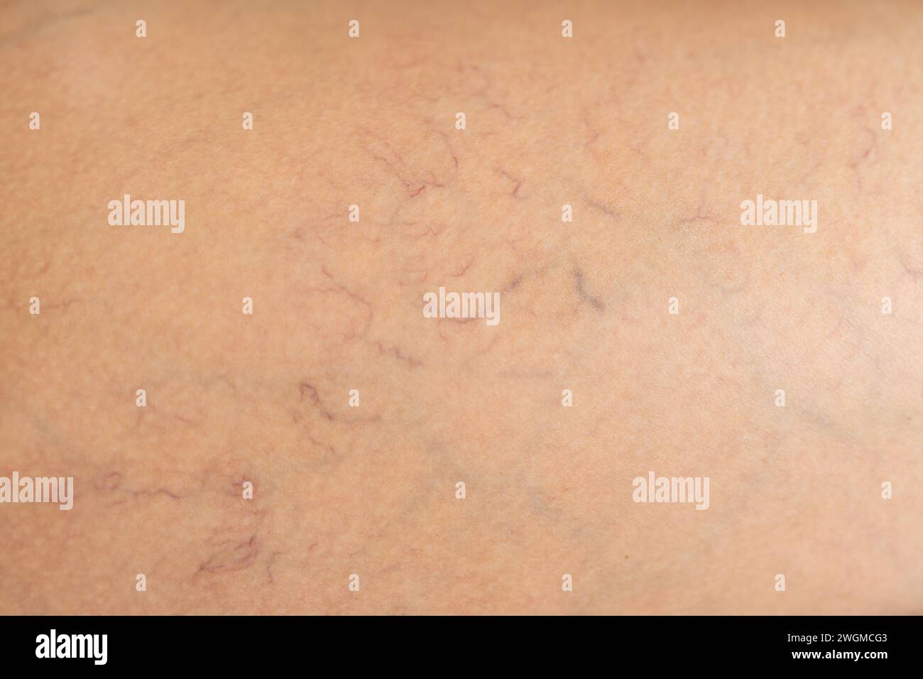 Varicose veins of small vessels on the skin of a woman's thigh Stock ...