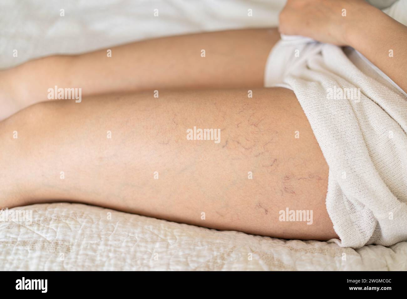 Varicose veins of small vessels on the skin of a woman's thigh Stock ...