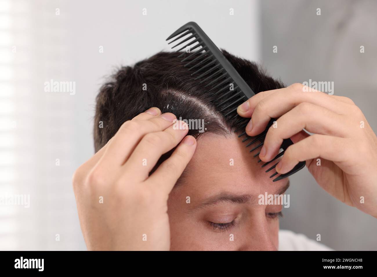 Dandruff problem. Man with comb examining his hair and scalp on light ...