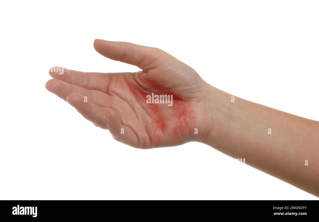 Hand burn scar Cut Out Stock Images & Pictures - Alamy