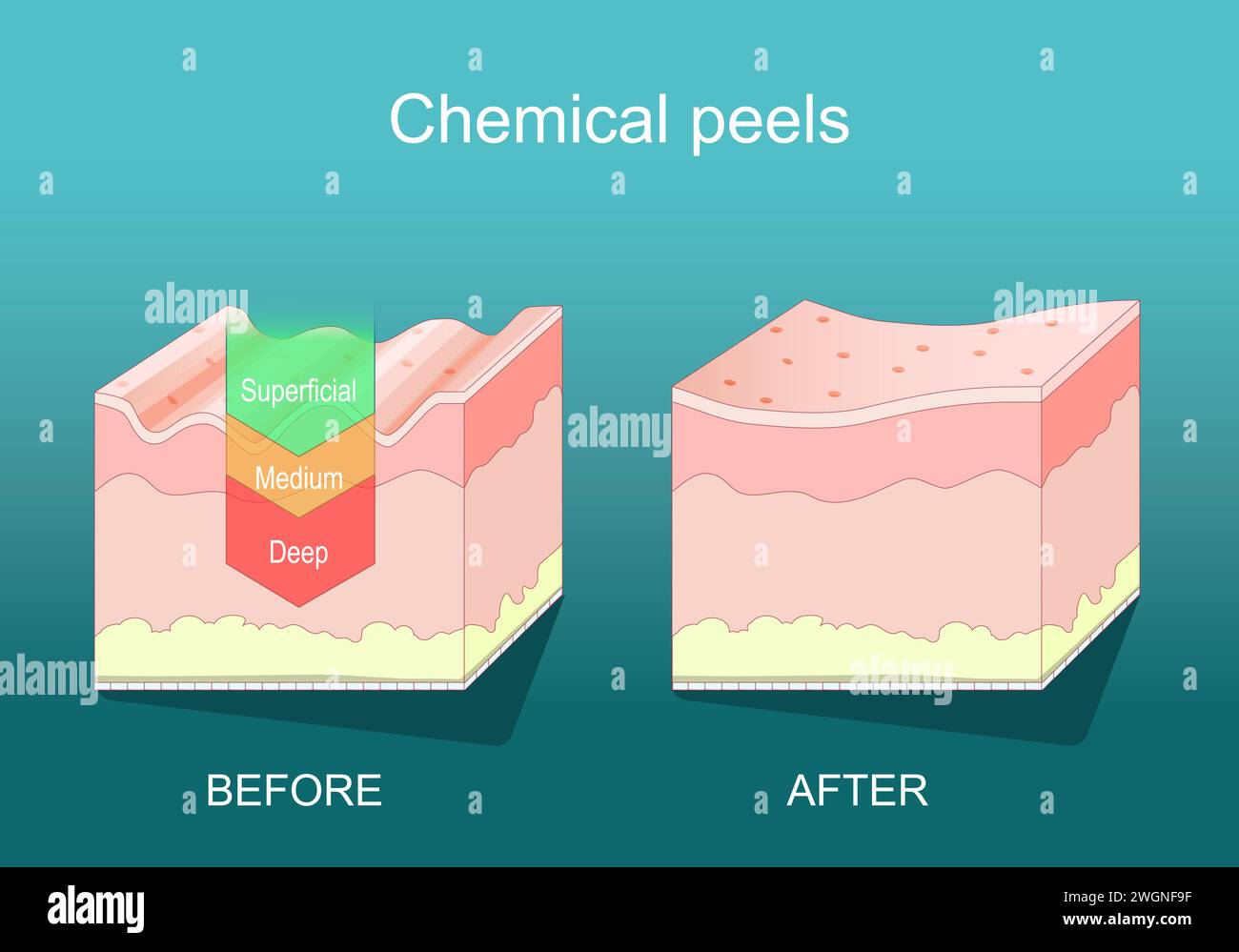 Chemical peel. Beauty aesthetic treatment. Deep, medium, Superficial ...