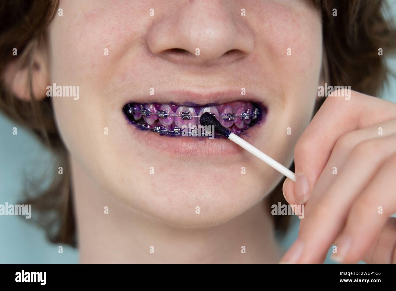 Plaque indicator on human teeth with braces. Plaque is colored pink ...