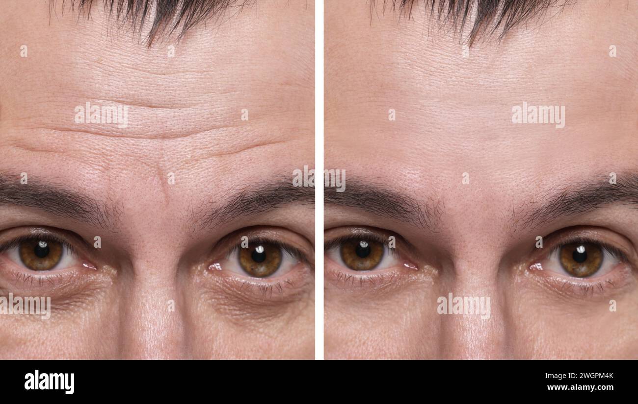 Aging skin changes. Man showing face before and after rejuvenation ...