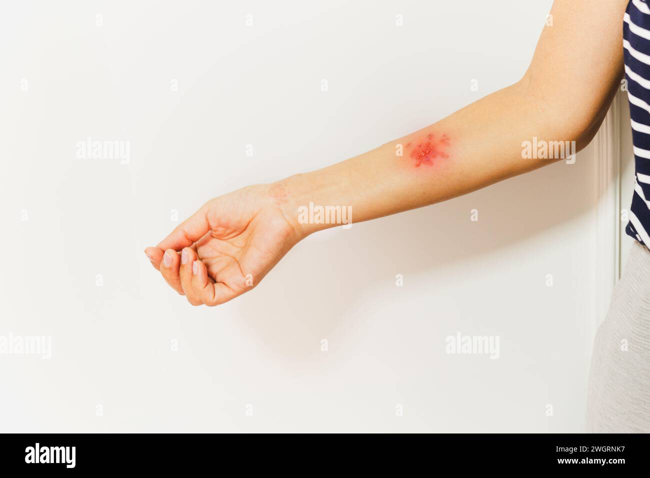 Shingles, Zoster or Herpes Zoster symptoms on womans arm isolated Stock ...