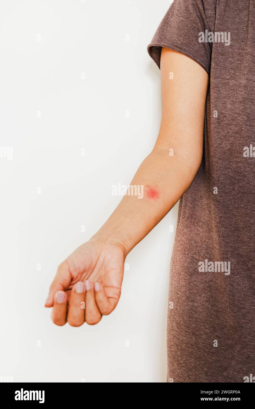 Shingles, Zoster or Herpes Zoster symptoms on womans arm isolated Stock ...