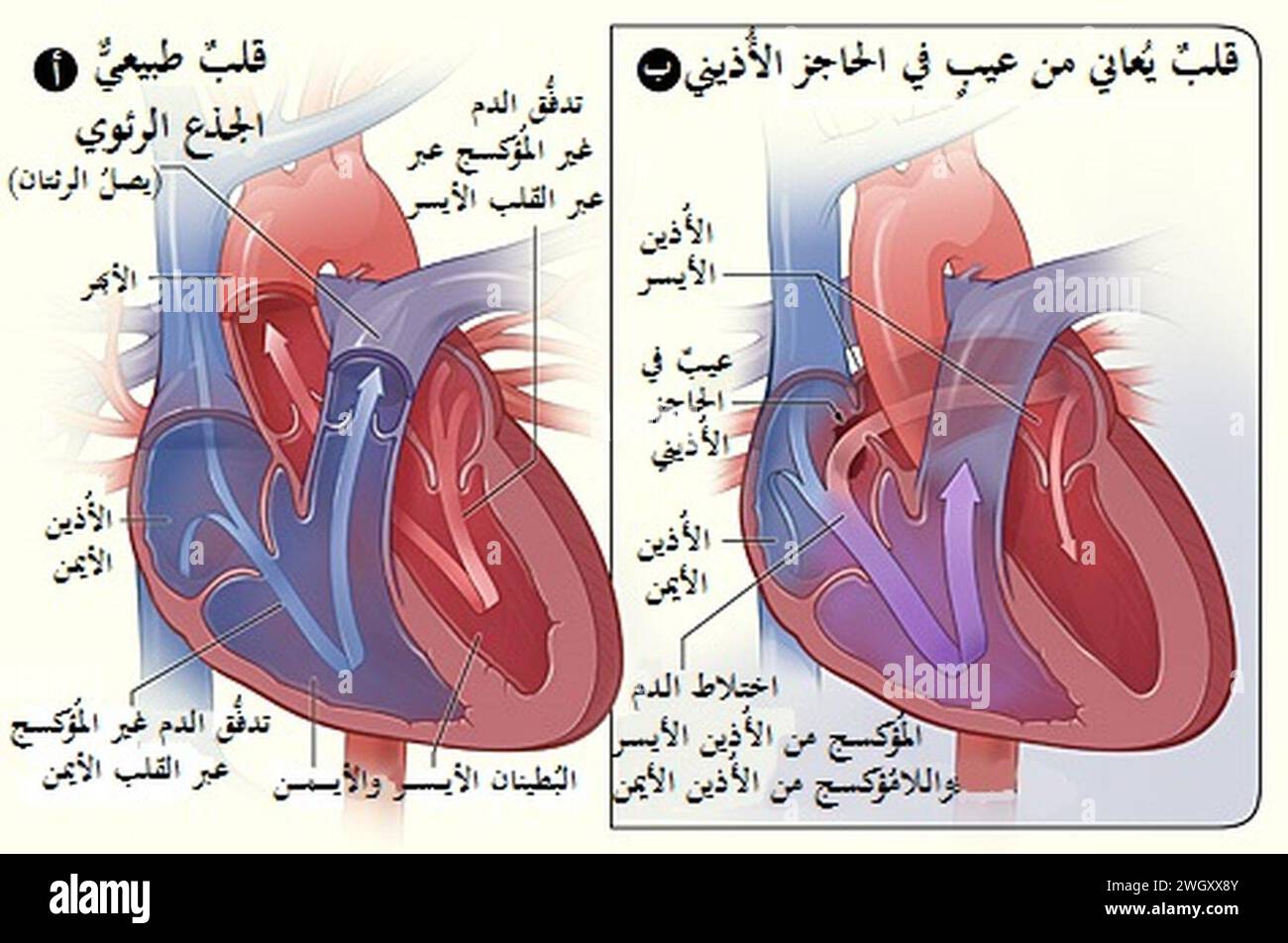 Atrial septal defect-ar Stock Photo - Alamy