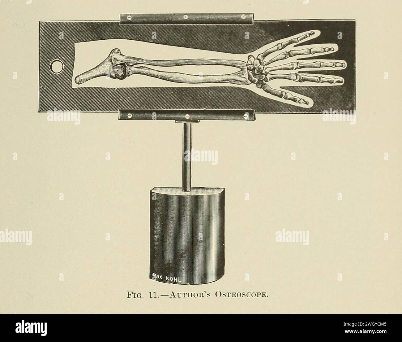 Author's osteoscope, extracted from Röntgen ray diagnosis and therapy ...