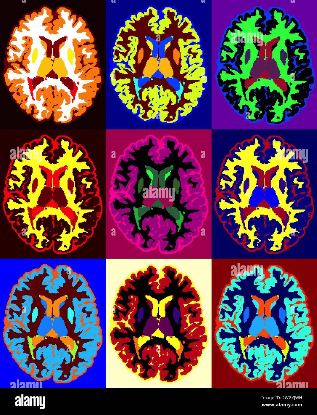 Axial Mri Scans Of A Person With Multiple Sclerosis 30208218503 Stock 0506