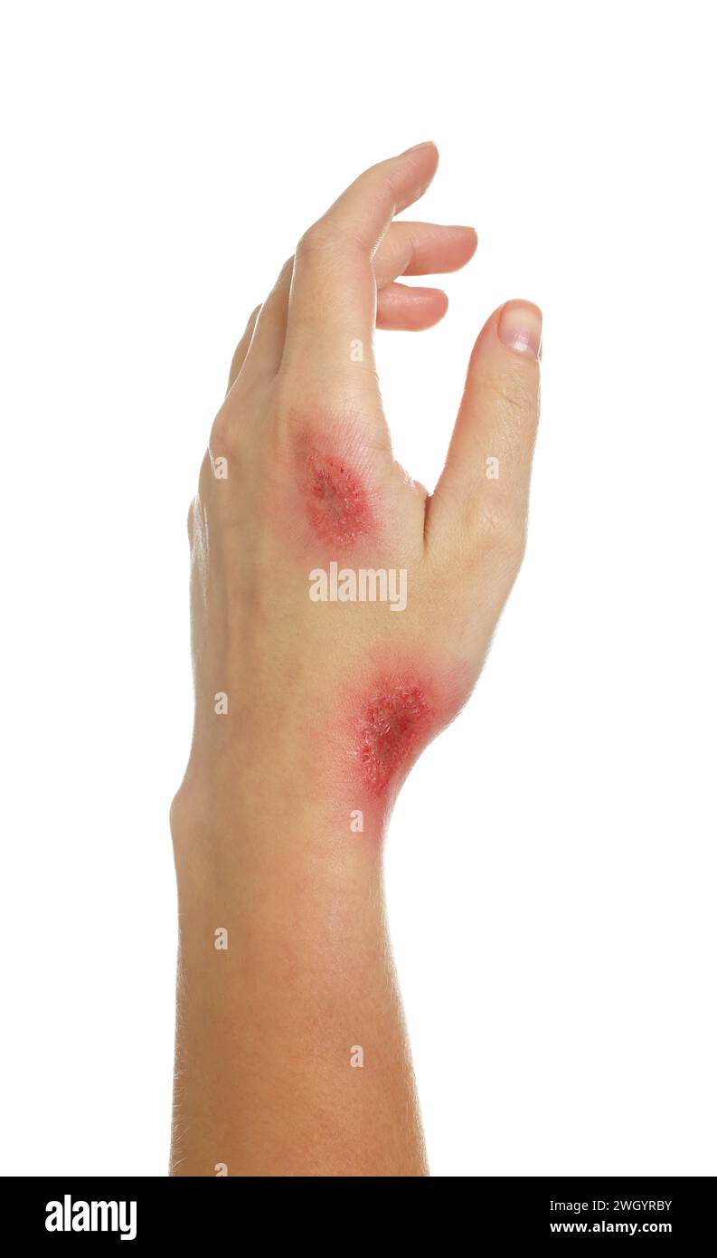 Burn mark on hand hi-res stock photography and images - Alamy
