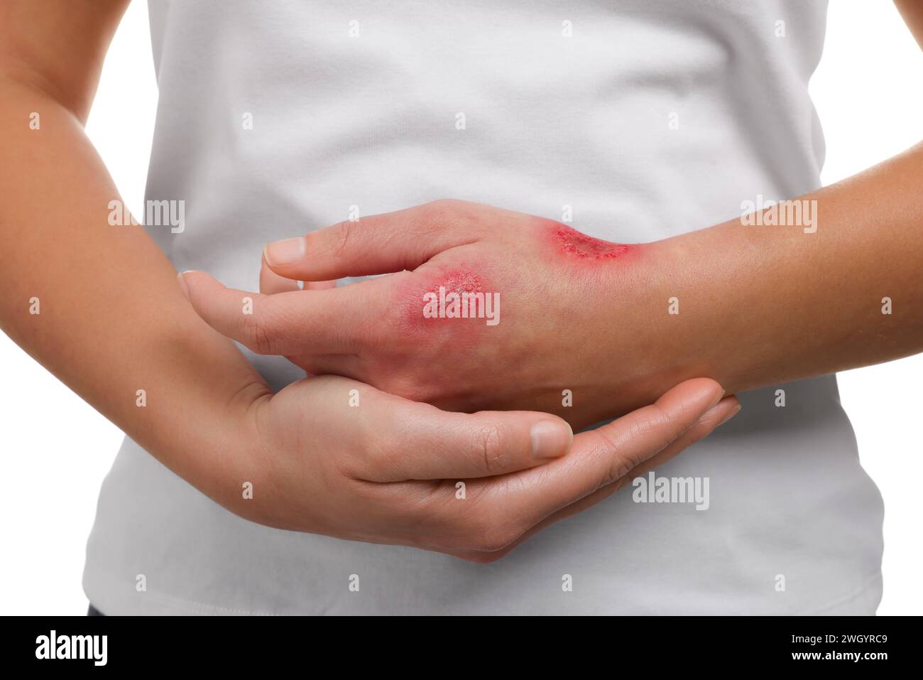 Burn mark on hand hi-res stock photography and images - Alamy