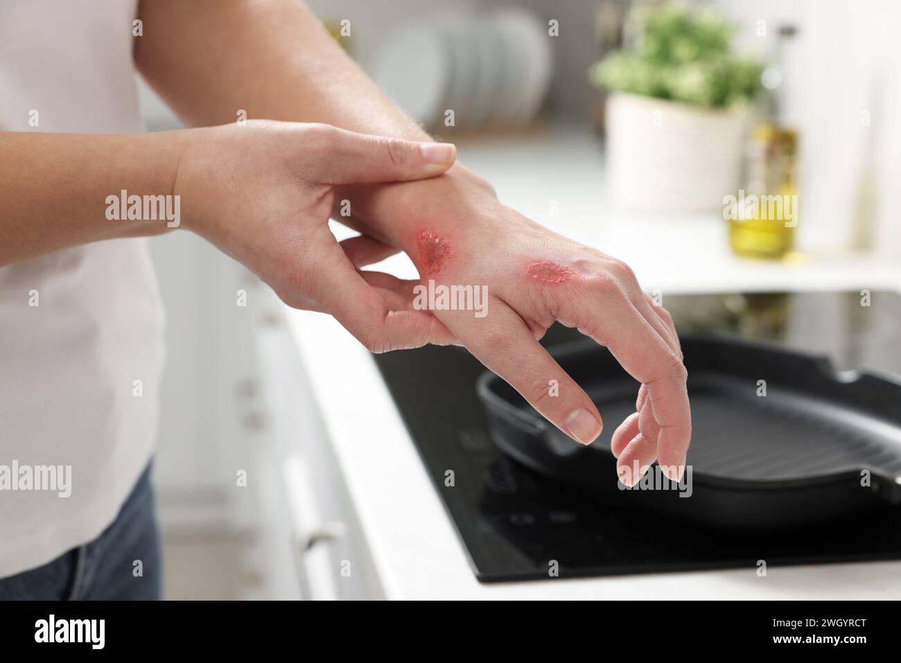 Burn mark on hand hi-res stock photography and images - Alamy