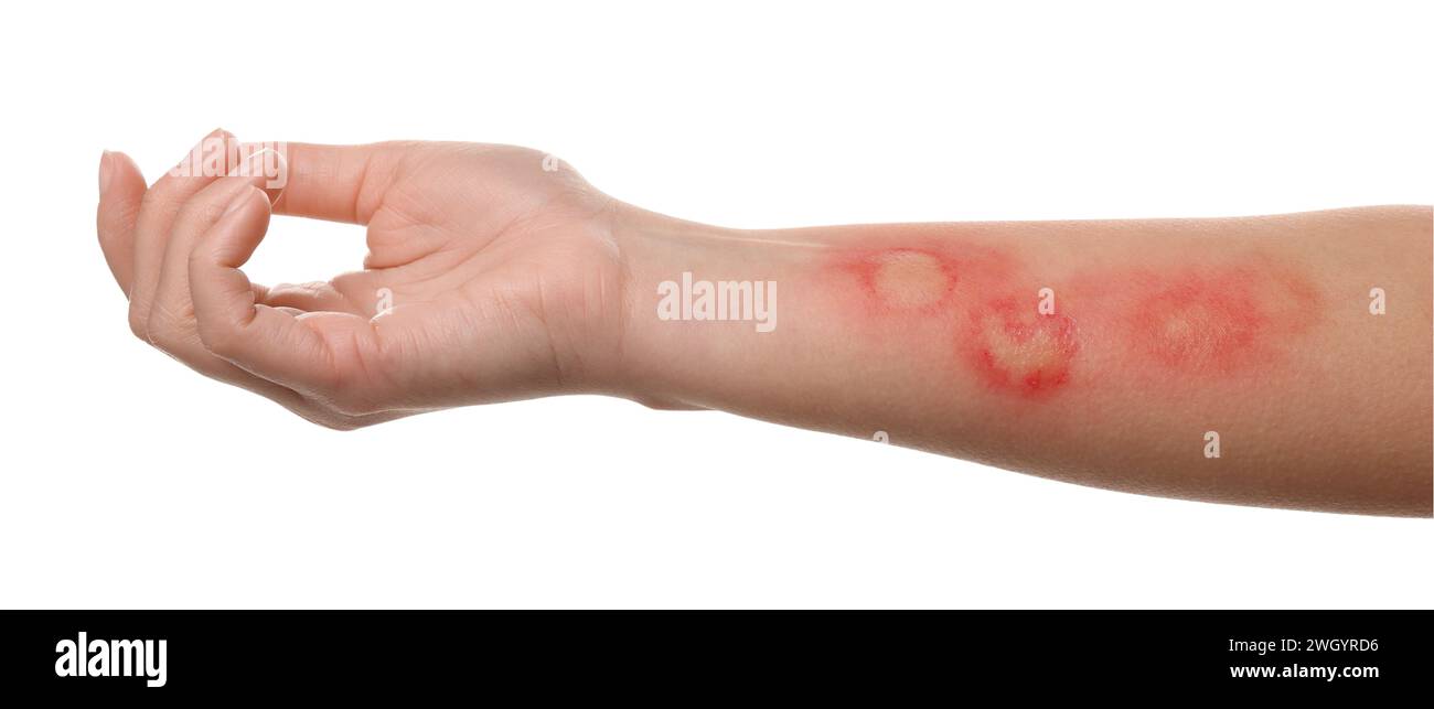 Burn mark on hand hi-res stock photography and images - Alamy