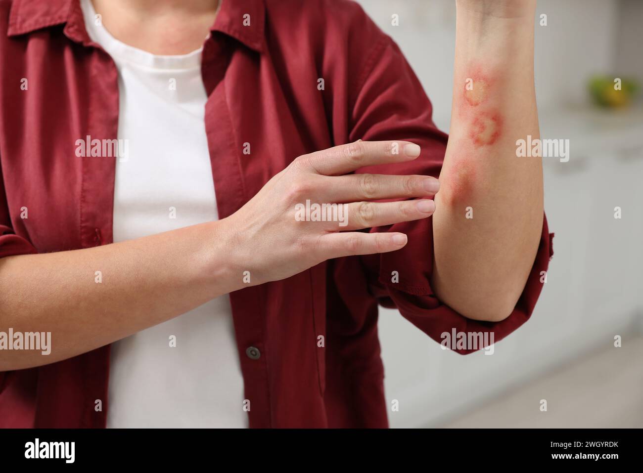 Burn mark on hand hi-res stock photography and images - Alamy