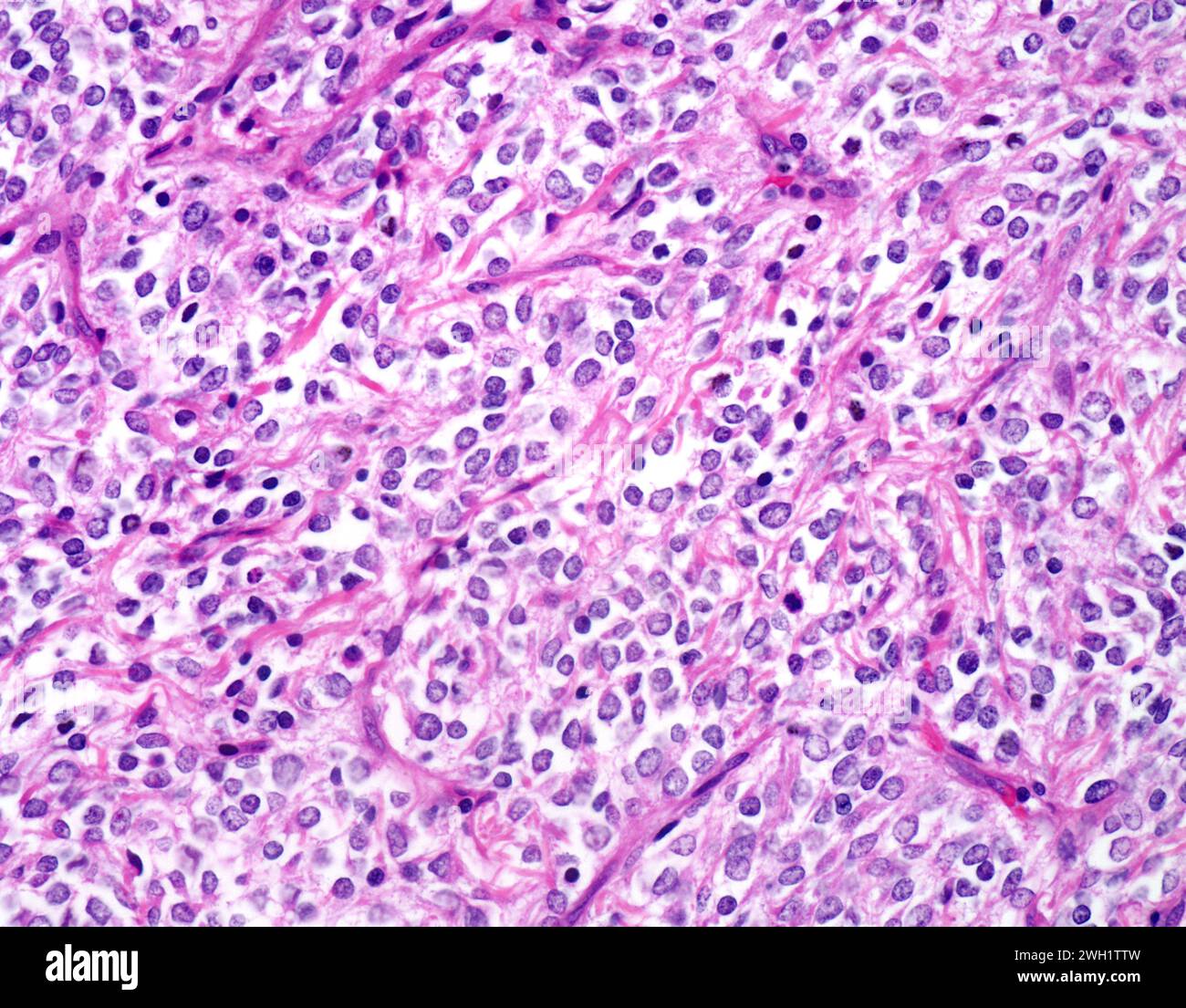 Clear cell sarcoma of kidney, light micrograph Stock Photo - Alamy