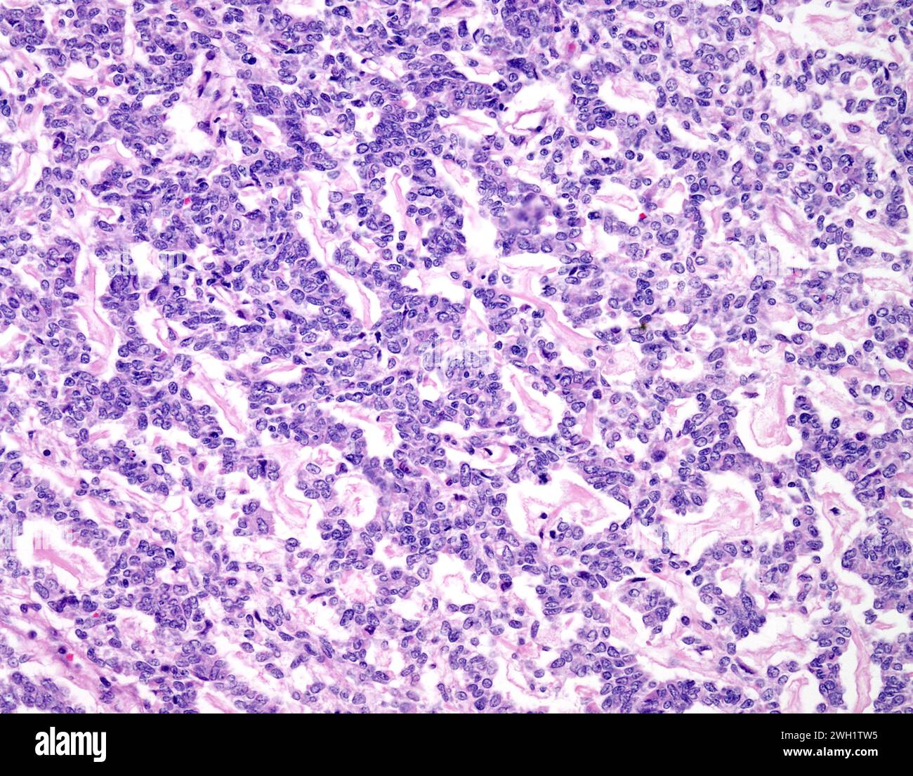 Clear cell sarcoma of kidney, light micrograph Stock Photo - Alamy