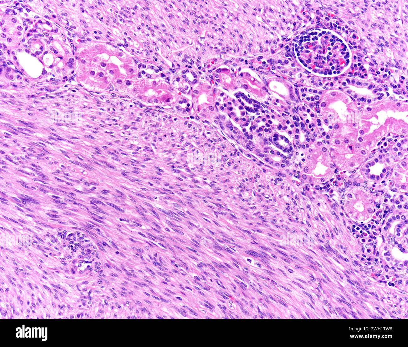 Congenital mesoblastic nephroma, light micrograph Stock Photo - Alamy
