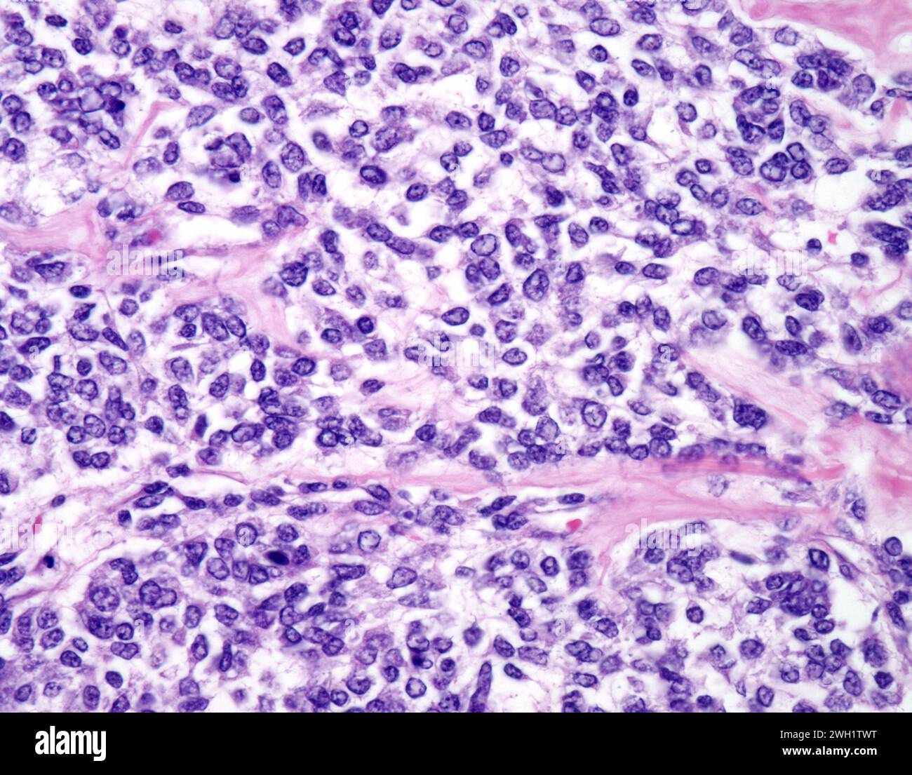 Clear cell sarcoma of kidney, light micrograph Stock Photo - Alamy