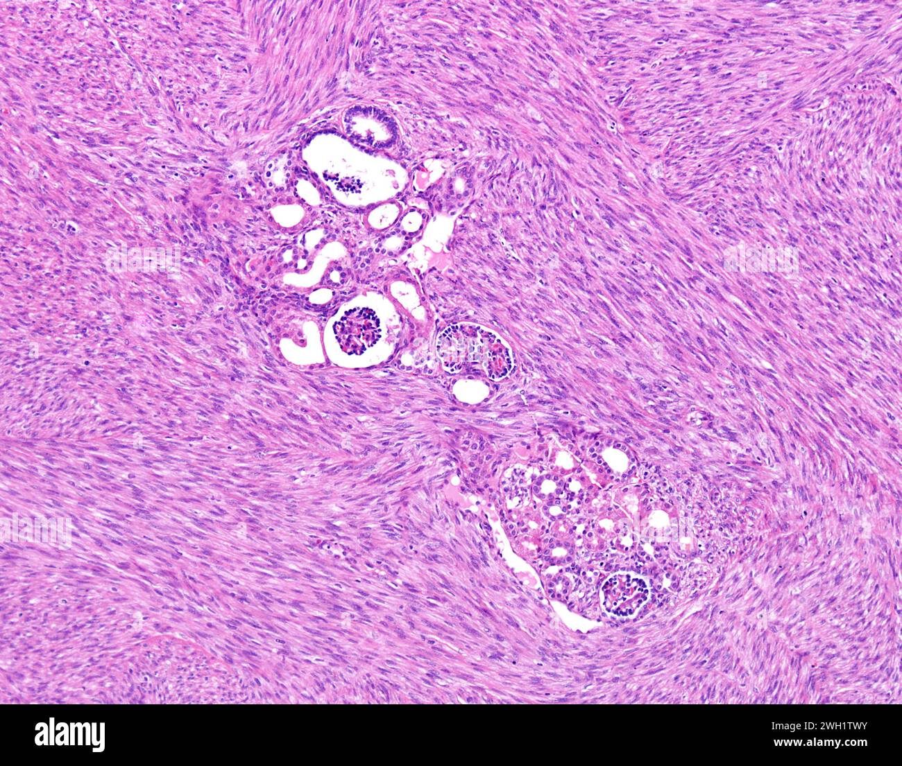 Congenital mesoblastic nephroma, light micrograph Stock Photo - Alamy