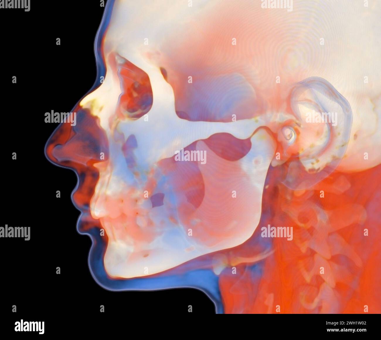 Head and neck bones, CT scan Stock Photo - Alamy