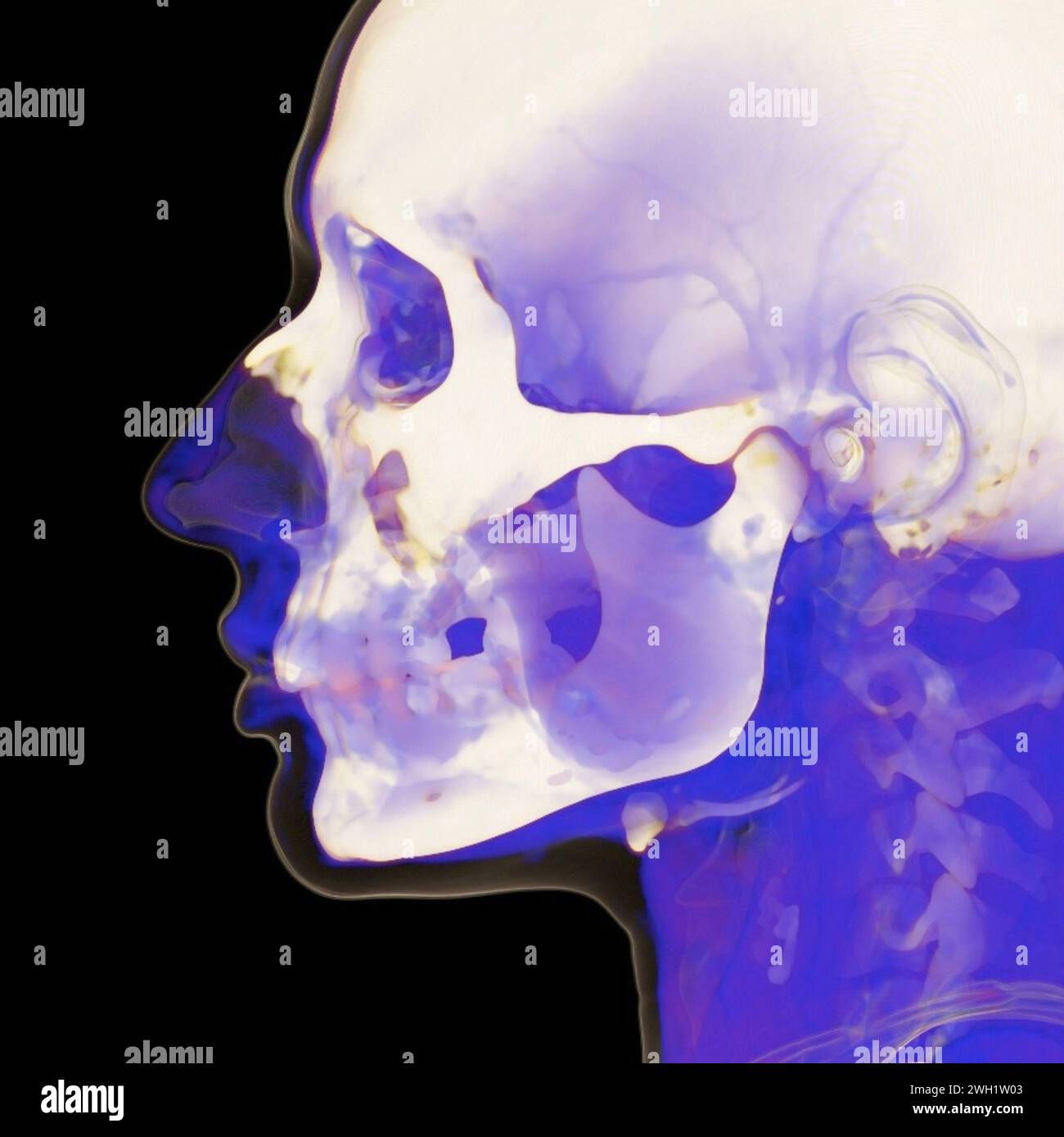 Head and neck bones, CT scan Stock Photo - Alamy