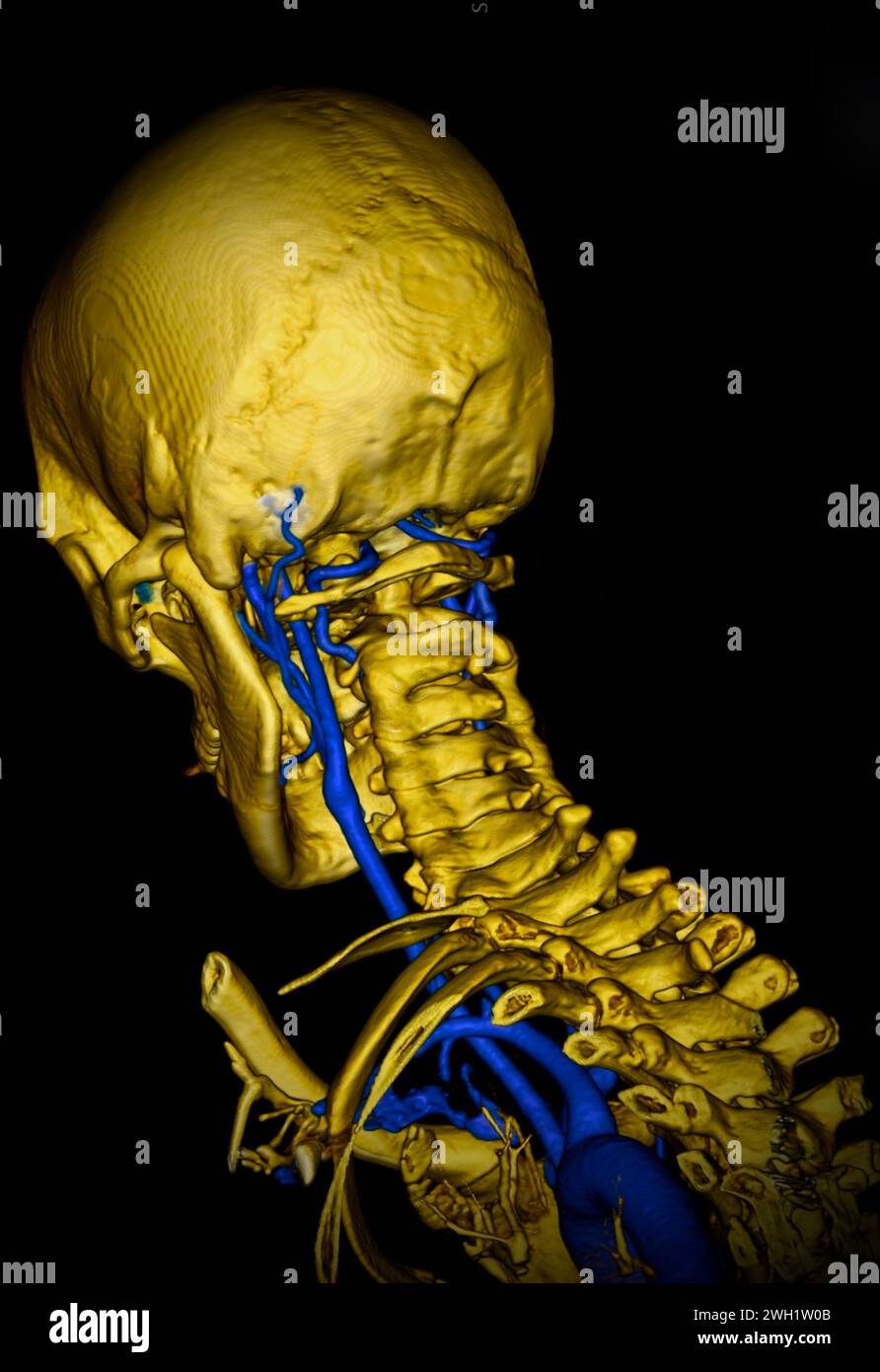 Arteries of the neck, CT angiogram Stock Photo - Alamy