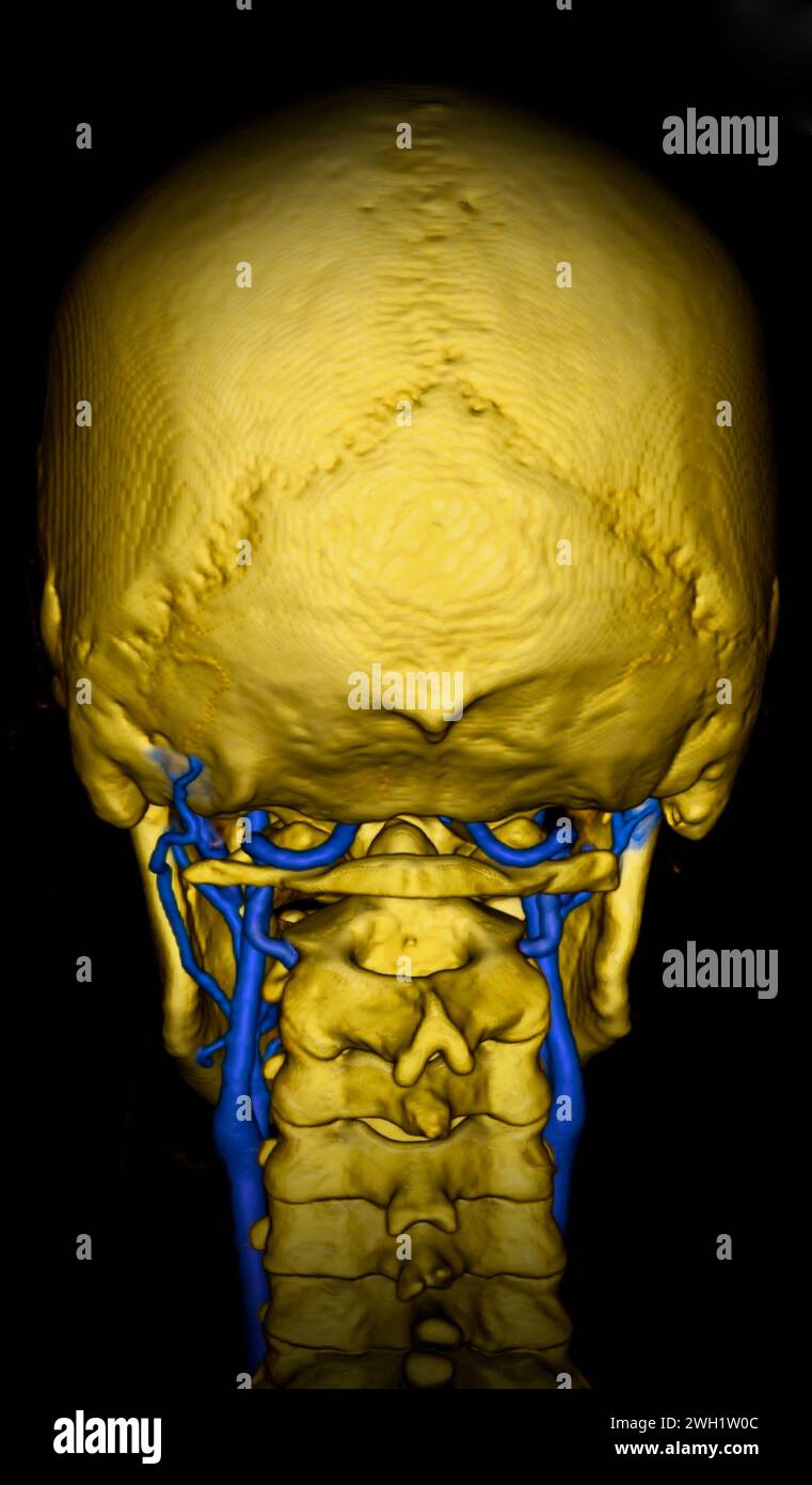 Arteries of the neck, CT angiogram Stock Photo - Alamy