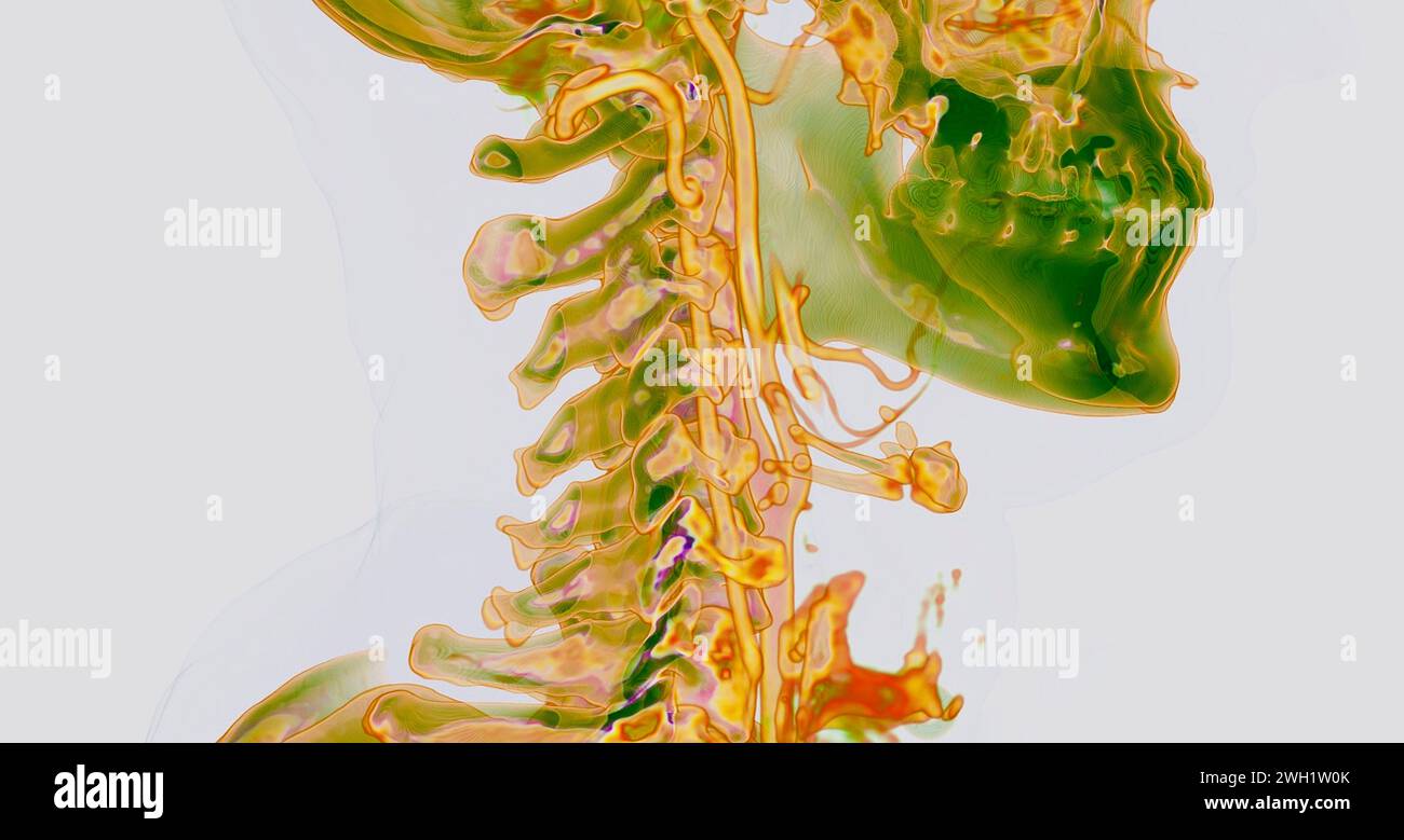 Arteries of the neck, CT angiogram Stock Photo - Alamy