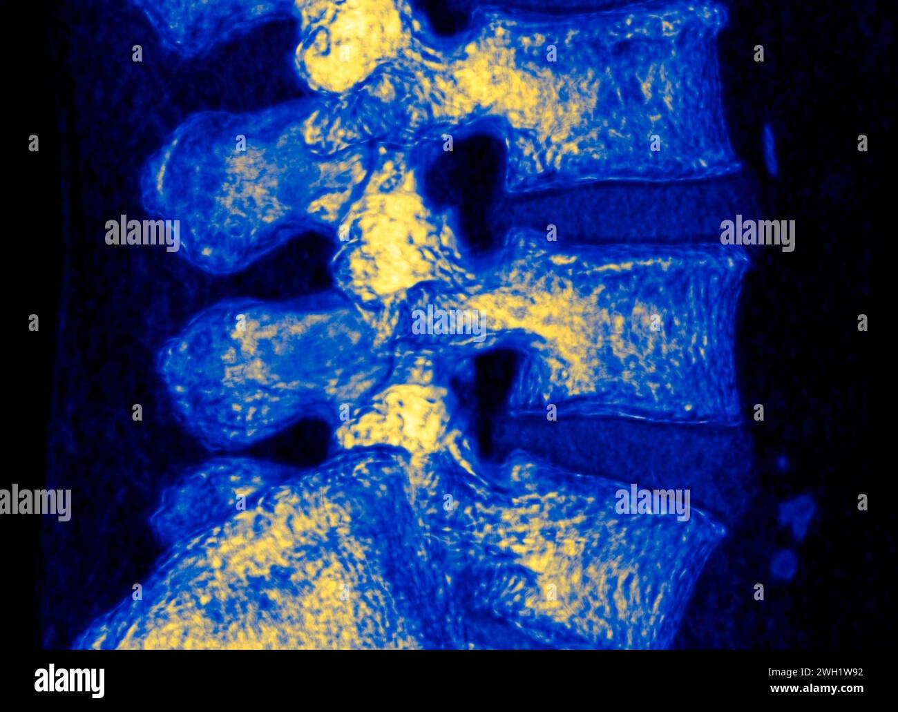 Lumbar spine, CT scan Stock Photo - Alamy
