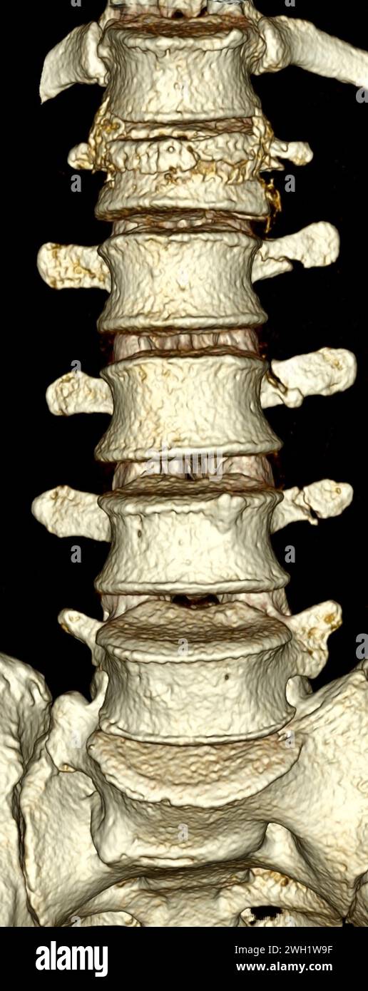 Lumbar spine, CT scan Stock Photo - Alamy
