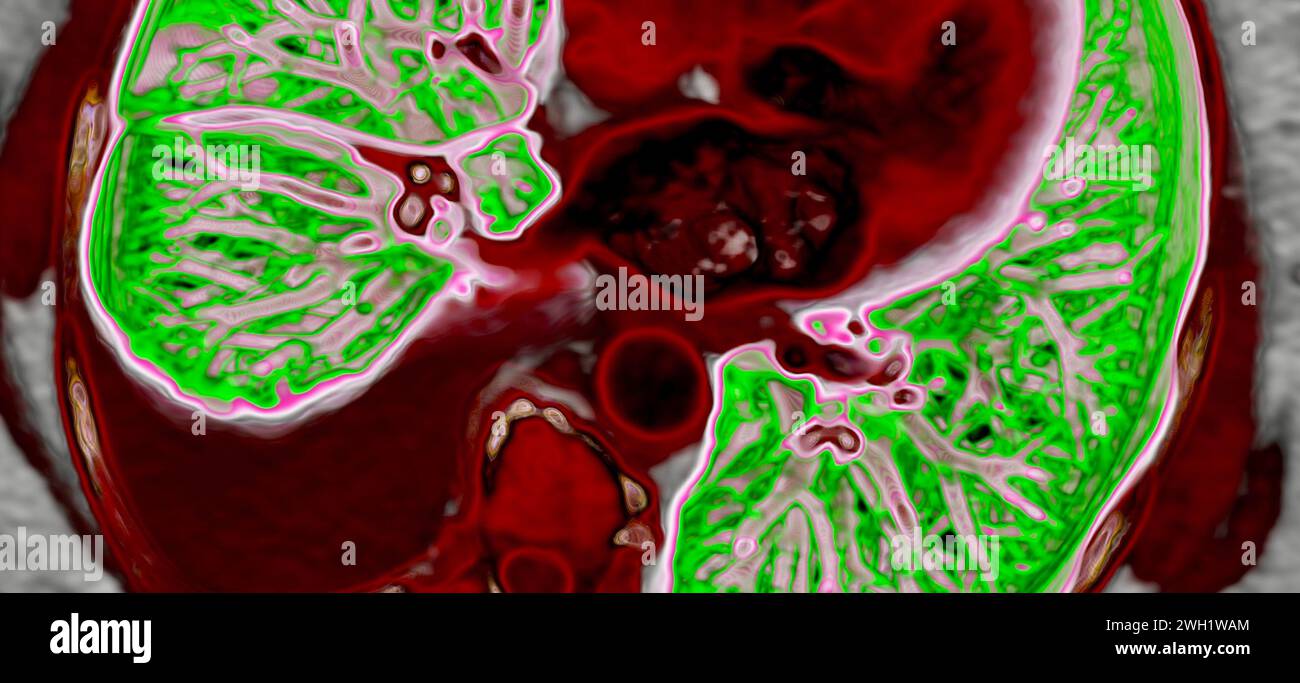 Pleural effusion, CT scan Stock Photo - Alamy