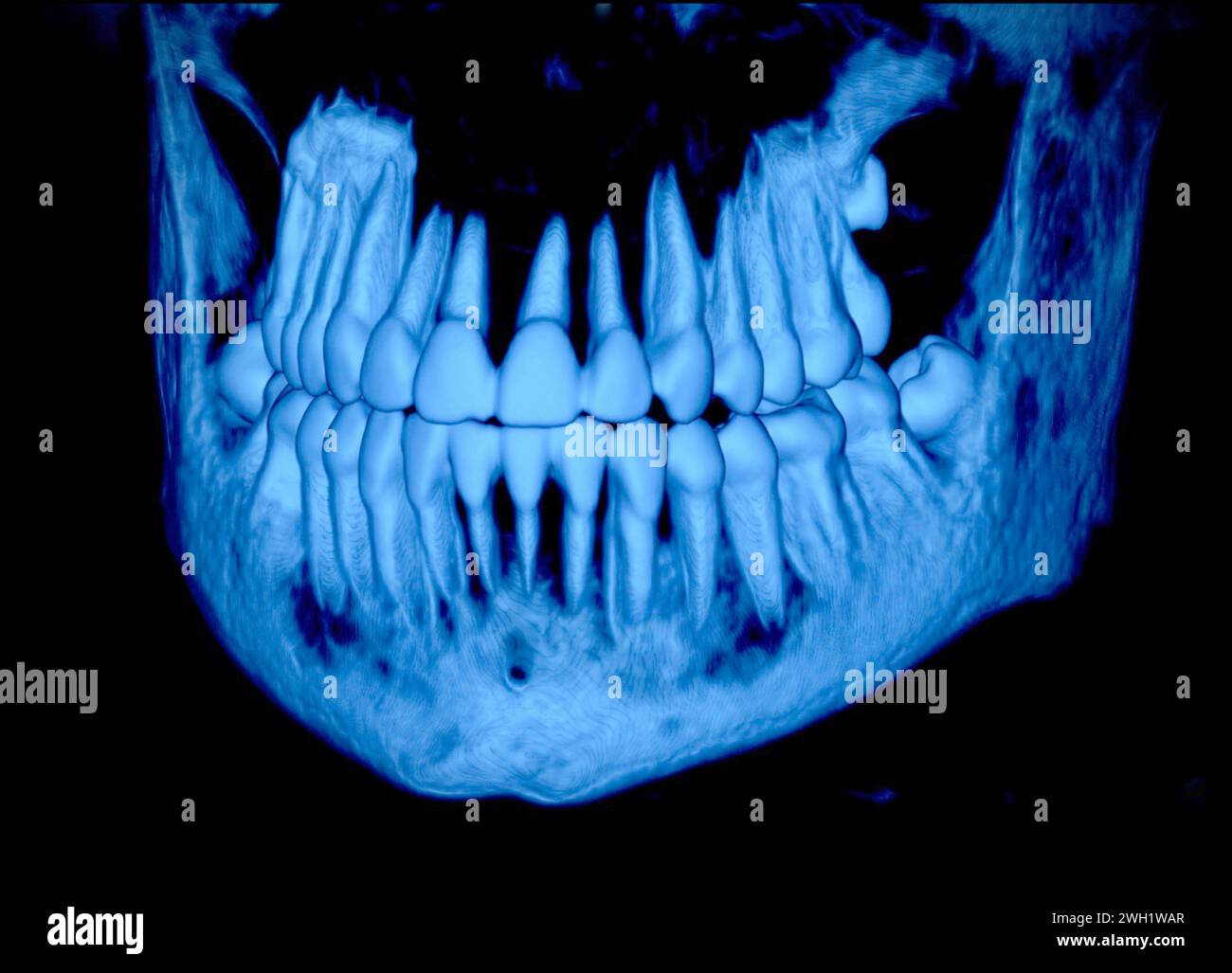 Jaw, CT scan Stock Photo - Alamy