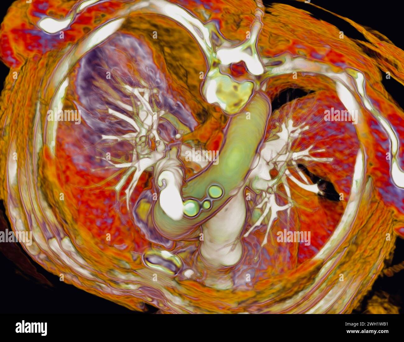 Thorax, CT scan Stock Photo - Alamy