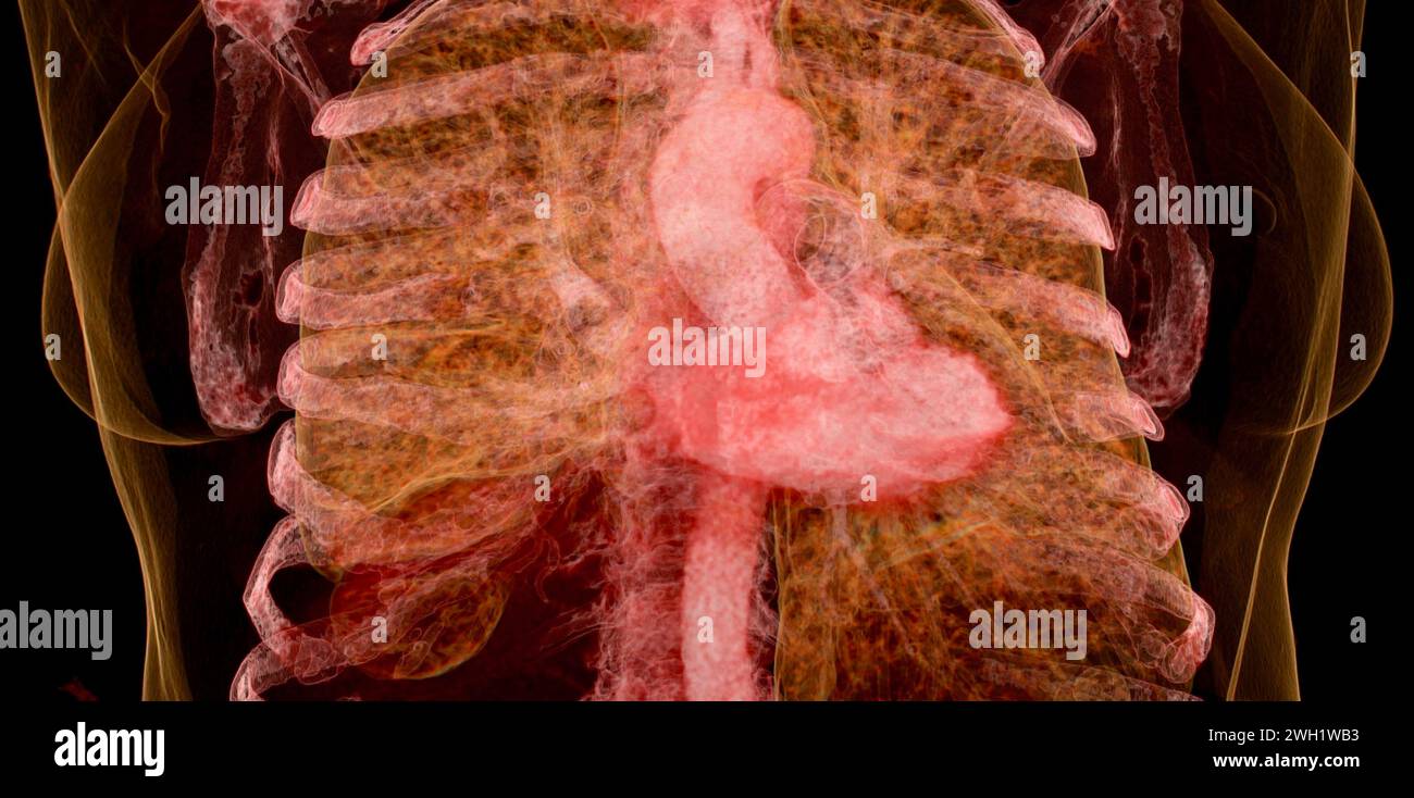 Thorax, CT scan Stock Photo - Alamy