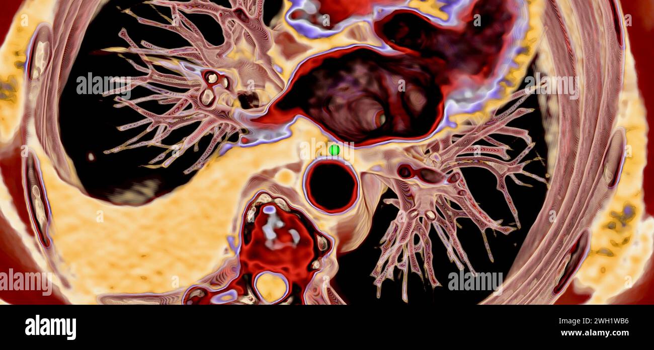Pleural effusion, CT scan Stock Photo - Alamy