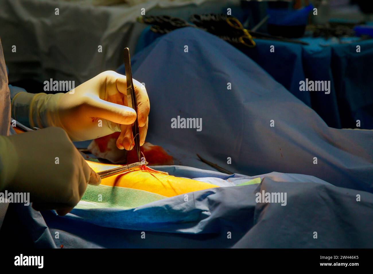 Laparoscopic procedure hi-res stock photography and images - Alamy