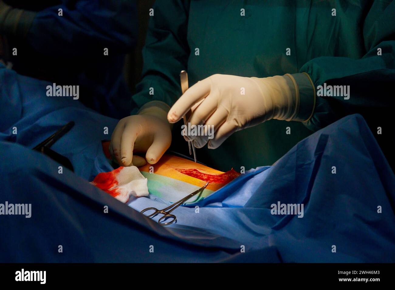 Laparoscopic procedure hi-res stock photography and images - Alamy