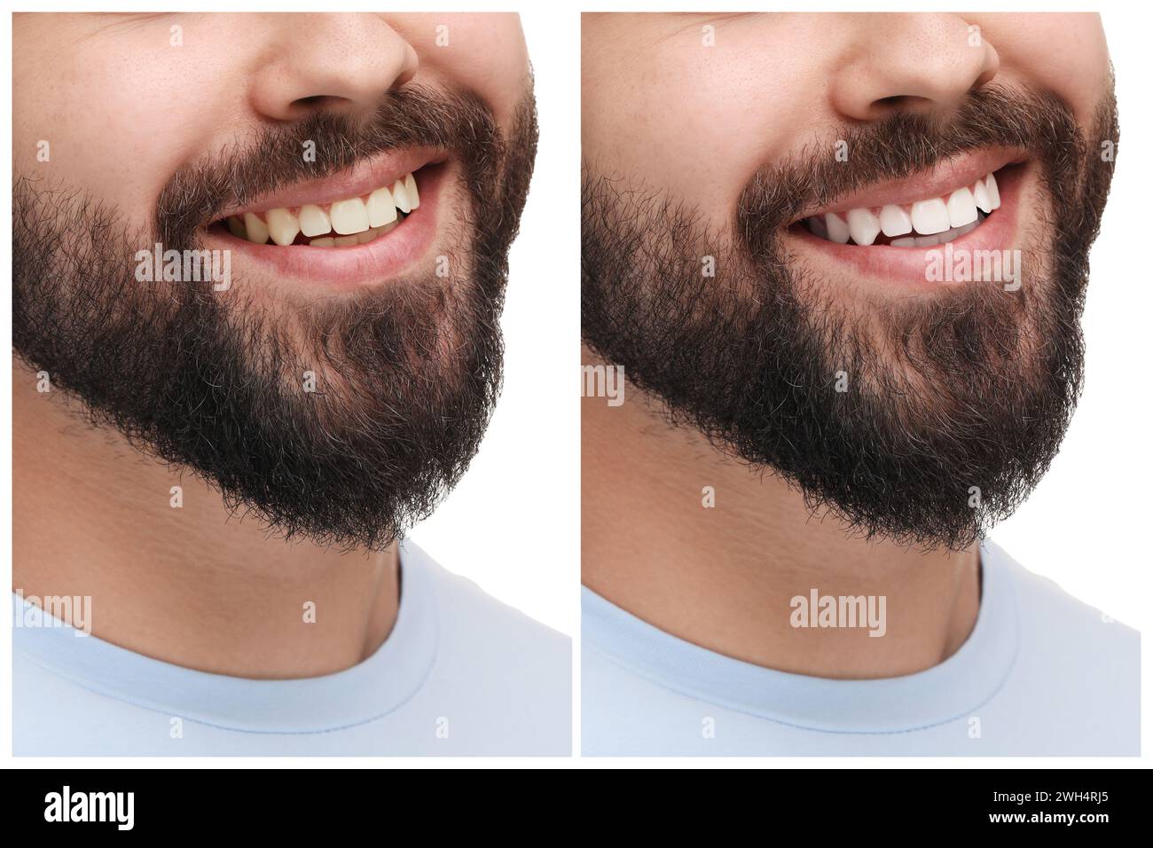 Man showing teeth before and after whitening on white background ...