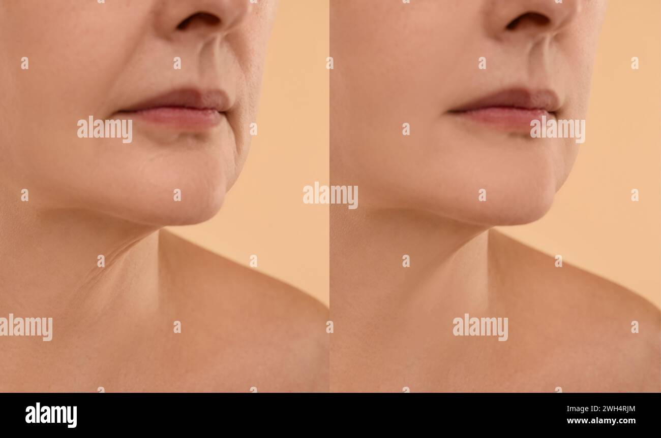 Aging skin changes. Woman showing neck before and after rejuvenation ...